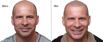 Scalp Micropigmentation | SMP Hair Good Look Ink