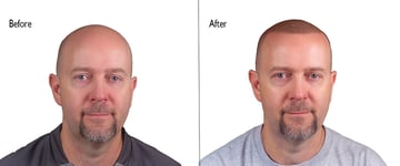 Scalp Micropigmentation | SMP Hair Good Look Ink