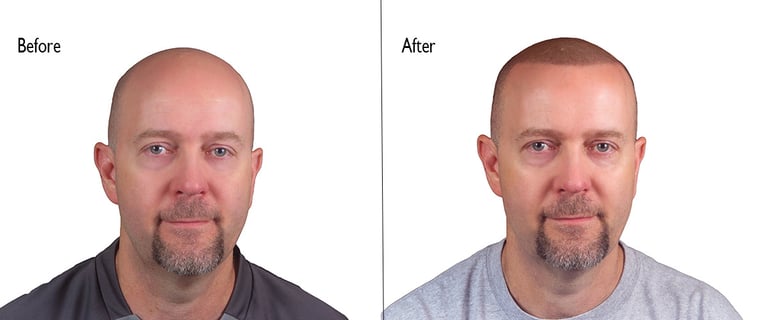 Scalp Micropigmentation | SMP Hair Good Look Ink