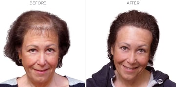 Scalp Micropigmentation | SMP Hair Good Look Ink