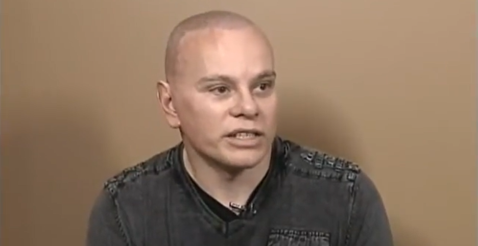 Neil’s Case Study – Hair Transplant Scar Camouflage