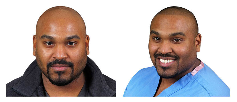 Scalp Micropigmentation | SMP Hair Good Look Ink